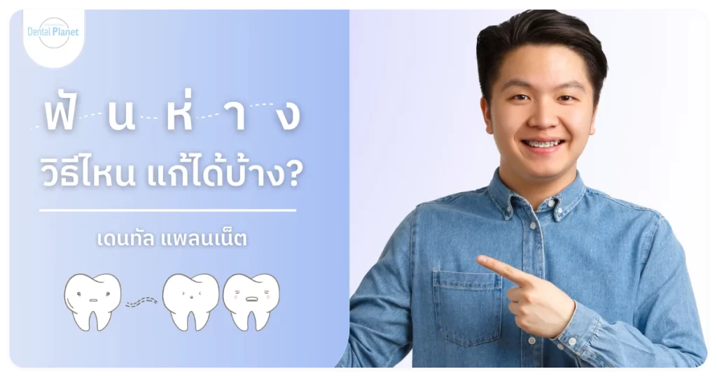 Close Teeth Gaps or Diastema Closing